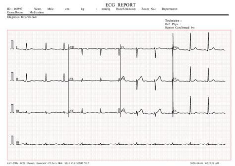 Ecg Lead Detection Object Detection Dataset And Pre Trained Model By Enetcom