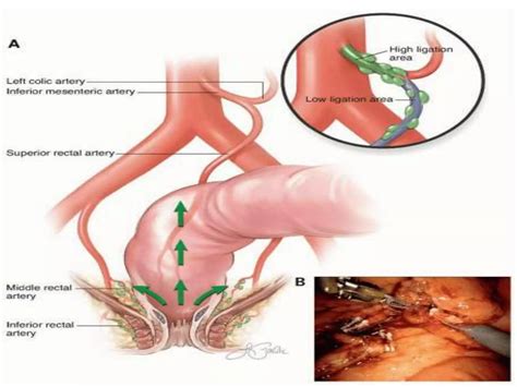 Low Ligation Of Inferior Mesenteric Artery In Laparoscopic Anterior Resection For Rectal Cancer