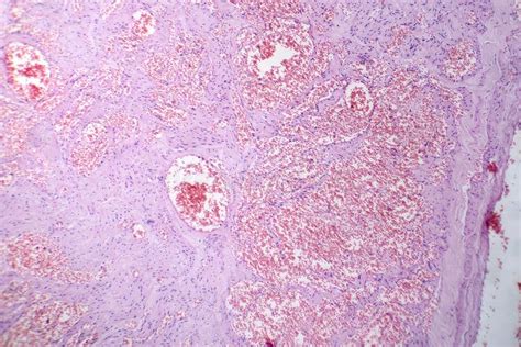 Capillary Hemangioma Light Micrograph Stock Image Image Of Health Histology 287868493