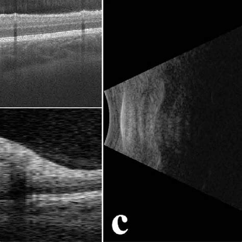 Preview Of The Posterior Segment Of The Patients Right Eye Oct Scan