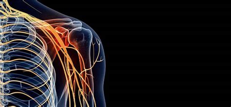 Brachial Plexus Neuritis Neuropathy San Jose Get Brachial Plexus