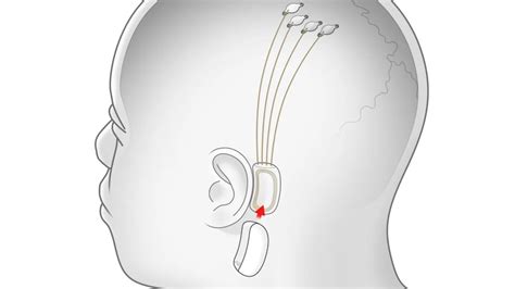 Elon Musks Neuralink Faces Federal Probe Employee Backlash Over