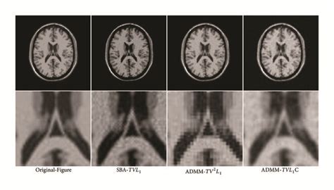 A Novel Model And Admm Algorithm For Mr Image Reconstruction Zhou