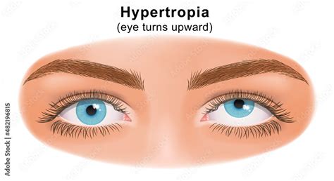 Squint Eye Strabismus Hypertropia Eye Turns Upward Deflection Of