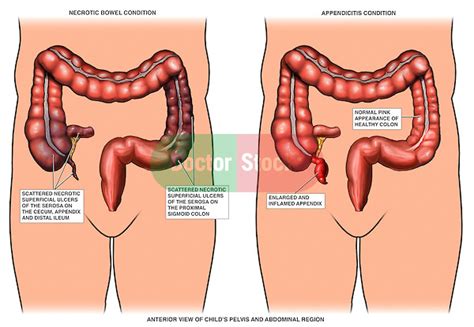 Human Appendix Inflamed