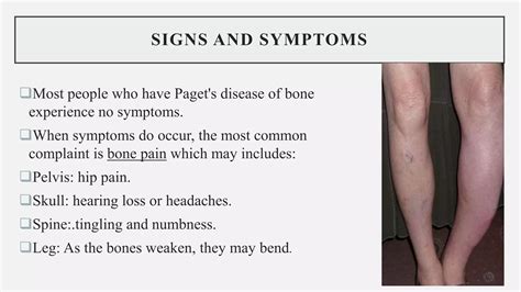 Pagets Disease Ppt Pptx