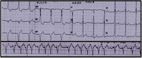 Ecg Demonstrating Wpw Type B Pattern And Atrial Fibrillation Download Scientific Diagram