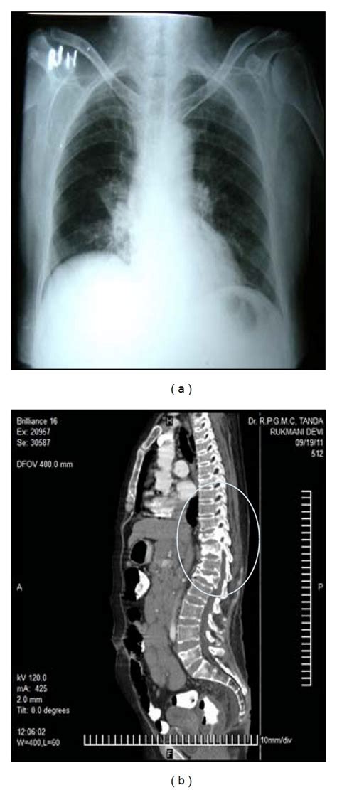 Segmental Atelectasis In Right Parahilar Region And Bilateral Hilar Download Scientific Diagram