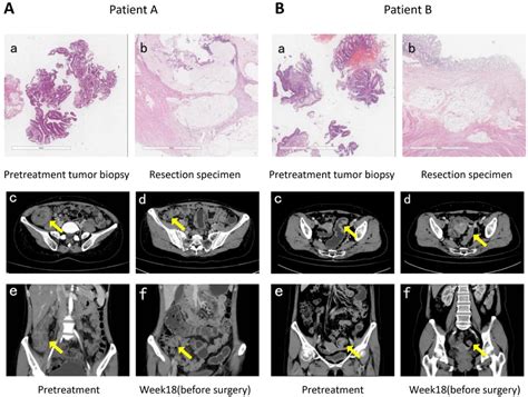 Single Agent Neoadjuvant Immunotherapy With A Pd 1 Antibody In Locally Advanced Mismatch Repair