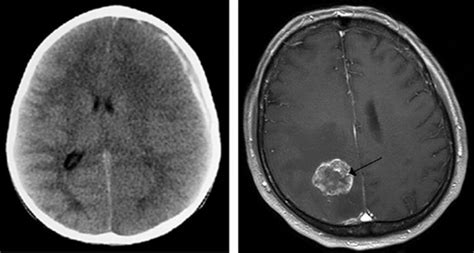 Left Normal Human Brain On A CT Scan Right A Tumor Growing Within Download Scientific