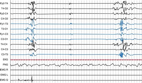 Electroencephalography In The Preterm And Term Infant Clinical Tree
