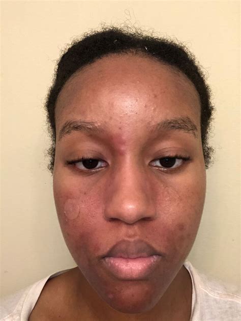 Pimple Patch Acne Overnight Pimples Hormonal Acne