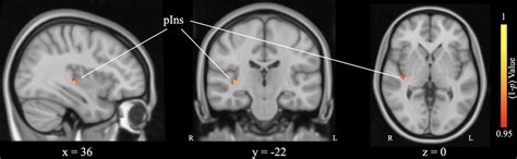 after acupuncture treatment patients with cnsp exhibited increased