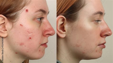 Rosacea Couperose Redness Skin Treatment Before And After Result Of