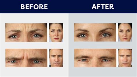 Botox Side Effects Droopy Eyelid