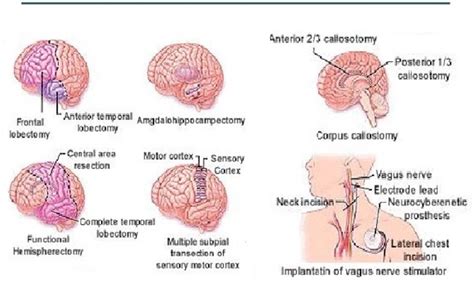 Table 1 From Overview Of Seizure And Epilepsy Syndromes And Their Multidisciplinary Management