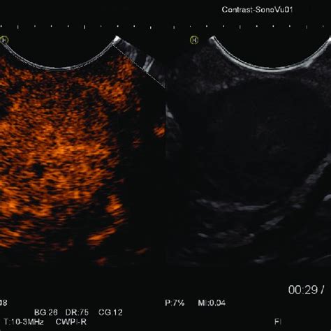 Gastrointestinal Stromal Tumors In Contrast‑enhanced Endoscopic Download Scientific Diagram