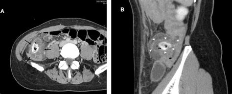 Abdominal And Pelvic Ct With Intravenous Contrast At The Time Of Download Scientific Diagram