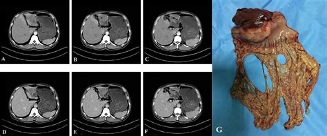 Cholangiocarcinoma Ultrasound