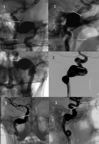 Four Fusiform Cavernous Segment Aneurysms All Sparing The Proximal Download Scientific Diagram