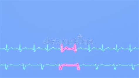 Ecg Of Cardiac Arrhythmias Right Bundle Branch Block And Left Bundle