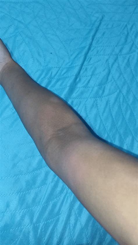 Spots Taking Dupixent R Eczemabs