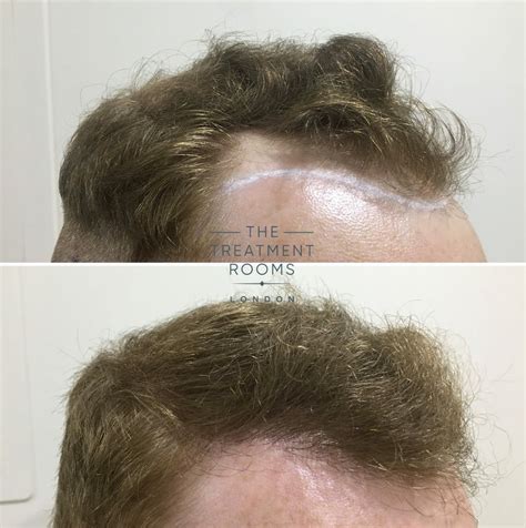 An In Depth Guide To Receding Hairline Treatment