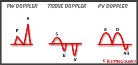 What Is Grade 1 Diastolic Dysfunction Mean Angelica Murrays 3rd