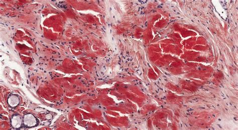 Amyloid Mypathologyreport