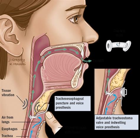 Tracheoesophageal Puncture Tep With Prosthesis This Procedure And Associated Device Is Another