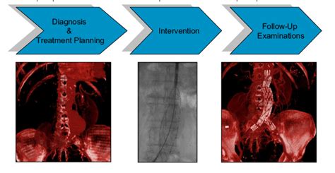 Workflow Of Evar Procedure Download Scientific Diagram