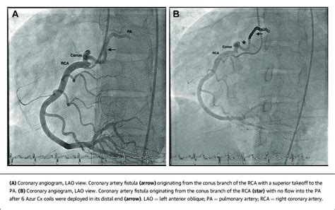 Coronary Angiogram Lao View Download Scientific Diagram