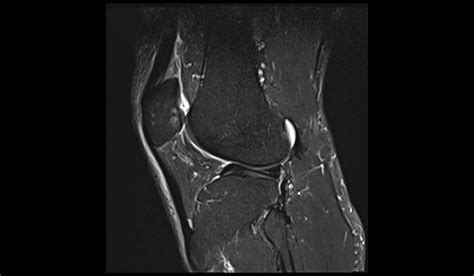 Chondromalacia Mri Radiology Article On Chondromalacia Patellae