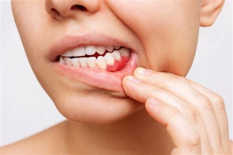 Dental Abscess Campbelltown Marketfair Dental Care