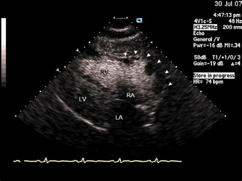 Contrast Perfusion Echocardiogram Reveals High Vascularity Of The Mass Download Scientific