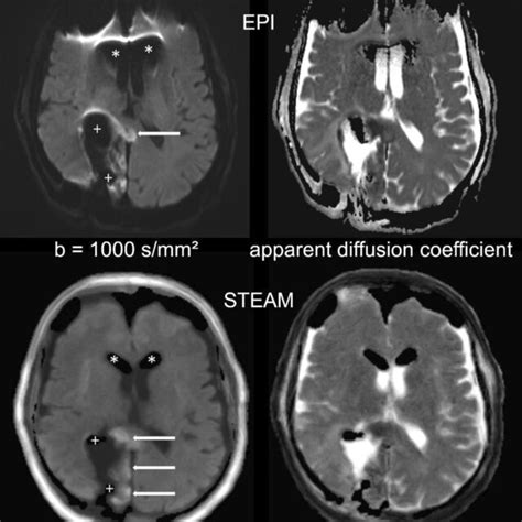81 Year Old Patient Postoperative Diffusion Weighted Images With