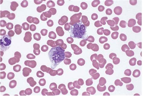 Monocytes Histiocytes And Storage Disorders Basicmedical Key