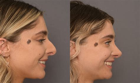 Rhinoplasty Cost Nose Job Cost Rhinoplasty London