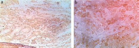 The Stathmin Expression And Its Significance With Other
