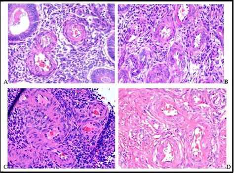 Uterine Vascular Hyperplasia Possible Cause Of Unknown Abnormal