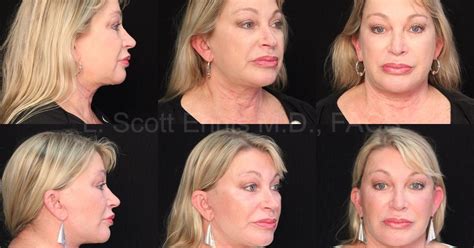 Buccal Fat Removal In Boca Raton Fl With Dr L Scott Ennis