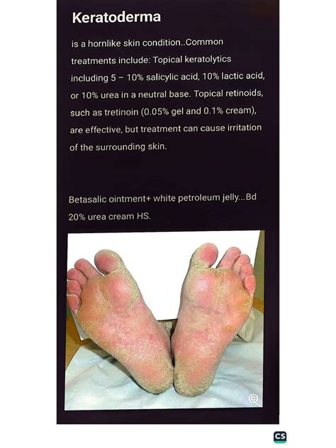 Keratoderma Pdf