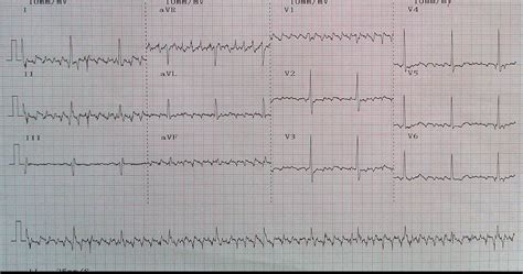 Phimaimedicine 562 Atrial Flutter