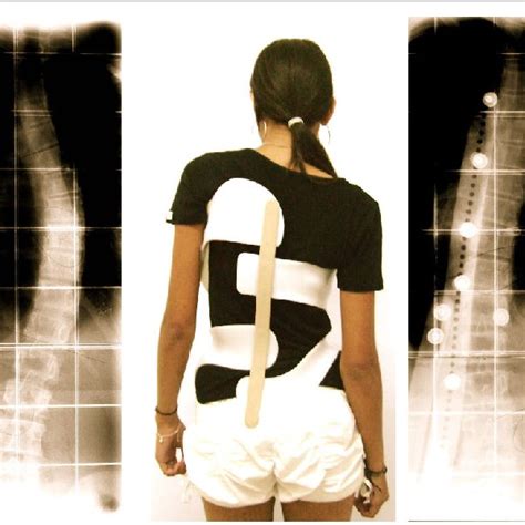 The Augmented Classification According To Lehnert Schroth Curvatures