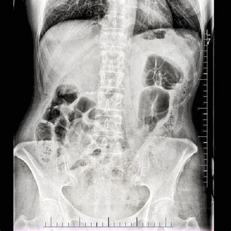 Patient 2 Abdominal Radiograph With Contrast Duodenal Diverticulum