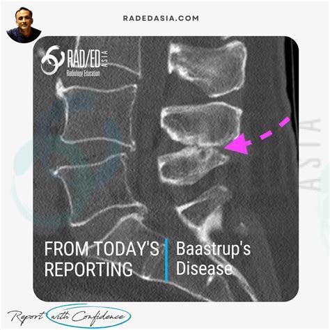 Baastrup Disease Ct Findings Radiology Education Asia