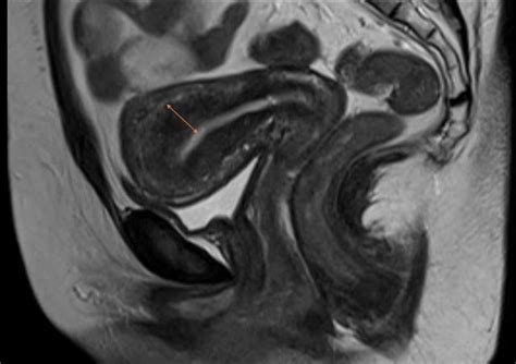 Ultimate Radiology Adenomyosis Of Uterus