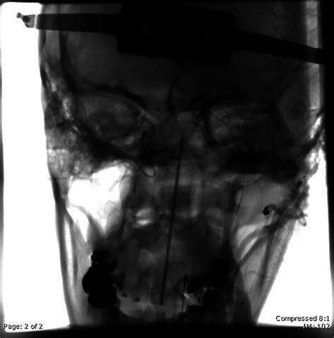 Direct Tumor Embolization Of Sinonasal Unclassified Spindle Cell Sarcoma With Onyx Pmc
