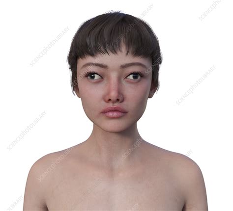 Woman With Exotropia Illustration Stock Image F0424830 Science