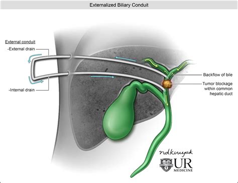 Percutaneous Biliary Drain Placement Njhw